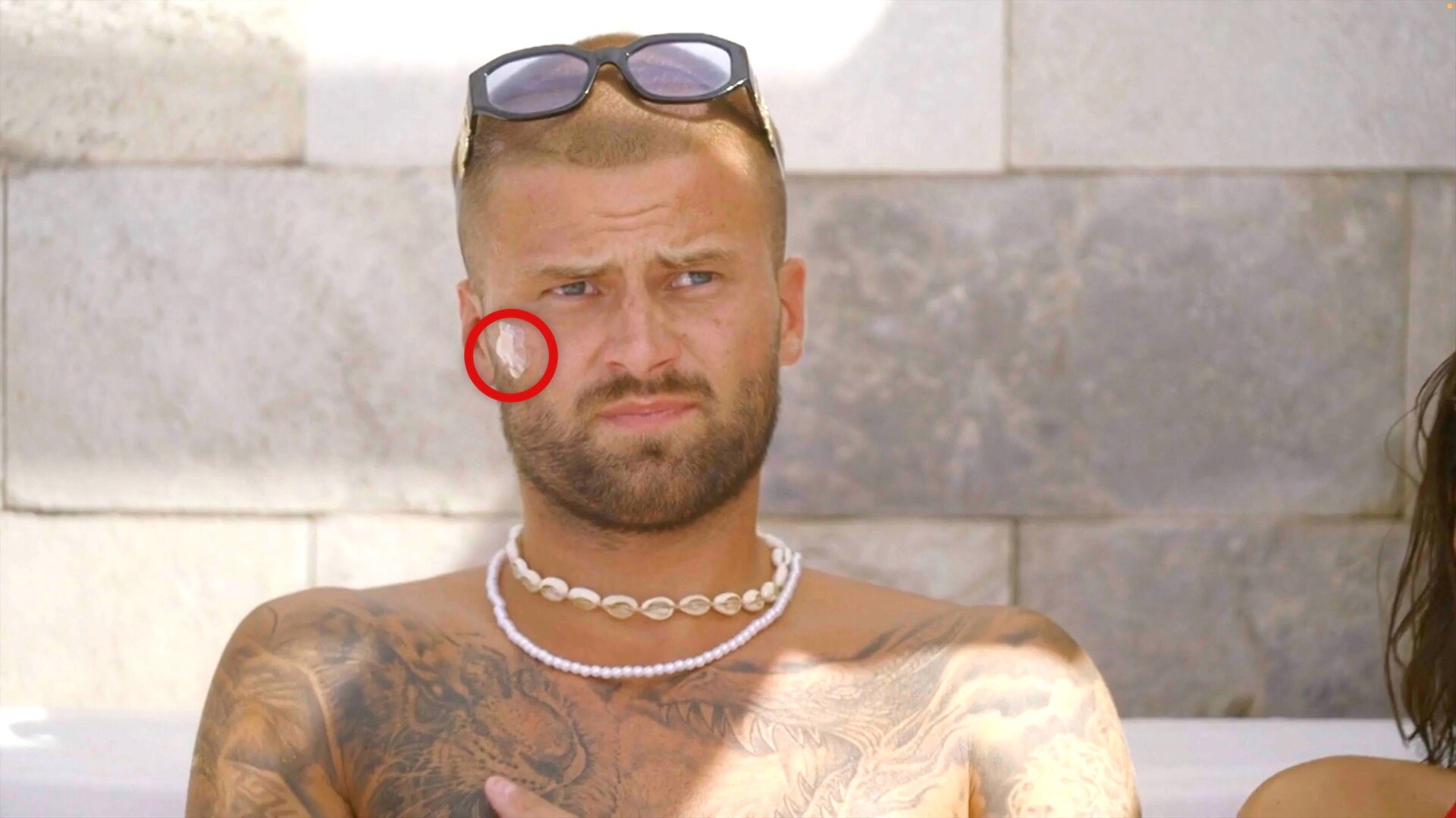 Mario Riera ble sendt til legevakten under innspillingen av «Ex on the ...